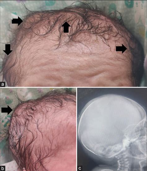 Seroma A Rare Cause Of Neonatal Scalp Swelling Indian Pediatrics
