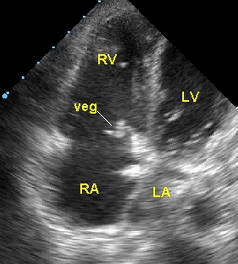 Vegetation On Tricuspid Valve Echocardiographic Image