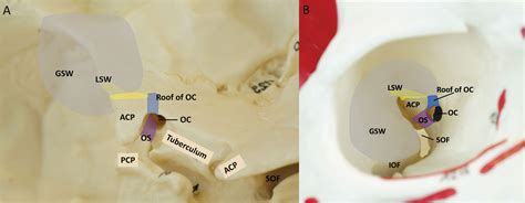 Frontiers Endoscopic Transorbital Extradural Anterior Clinoidectomy A Stepwise Surgical
