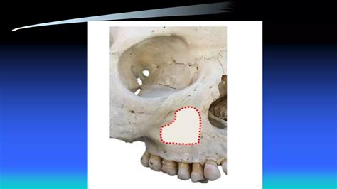 Maxillectomy And Craniofacial Resection Pptx Ear Nose And Throat