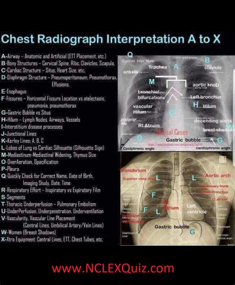 Chest Tube Cheat Sheet