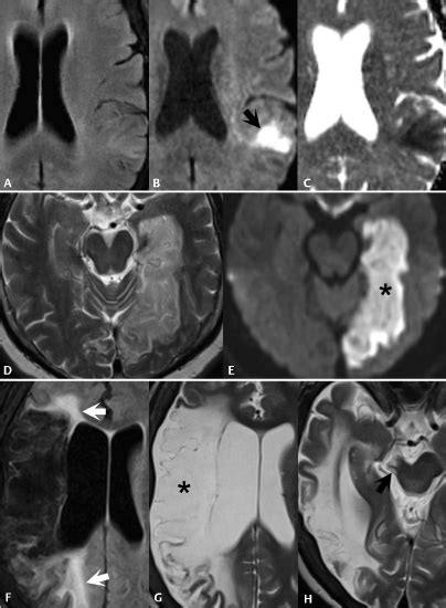 Ischemia And Infarction I Radiology Key