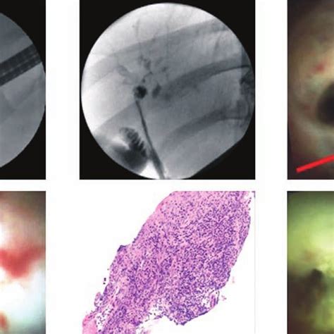 A A A A A ERCP Cholangiography Showing CBD Indentations And Download Scientific Diagram