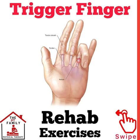 [manny And Angie] 🇺🇸🇨🇴 On Instagram “{👉 Swipe} To See Rehab Exercises For Trigger Finger 📝
