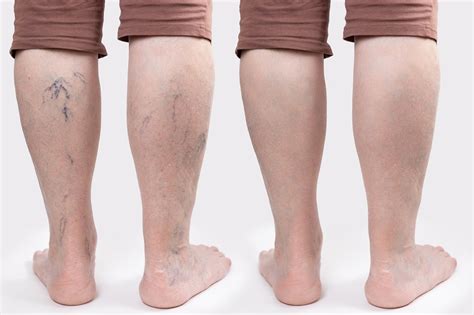 What Is Vein Restoration Usa Vein Clinics