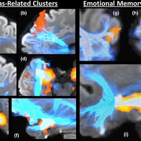 Results Of The Tract‐based Spatial Statistics Analysis Using Diffusion Download Scientific