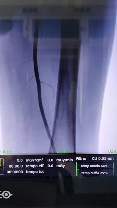 [video] Christian Baraldi On Linkedin Patient 71 Years Old With Critical Diabetic Arteriopathy