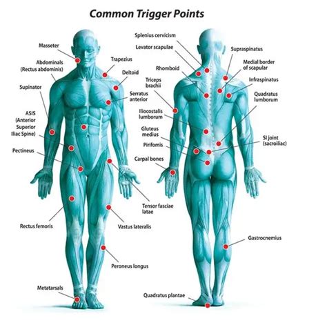 Trigger Point Injections In Tampa Bay Area St Petersburg Trigger Point Injections In Tampa Bay Area St Petersburg