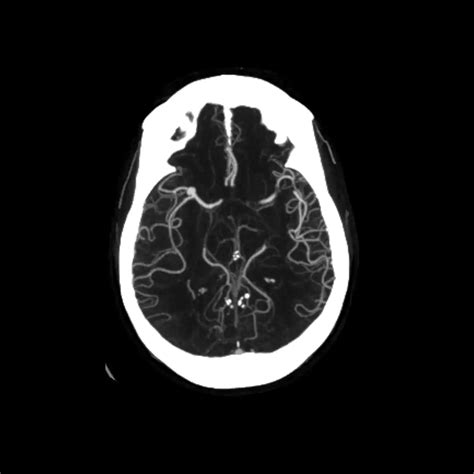 Viz™ Aneurysm Improves Detection Rates And Clinical Care