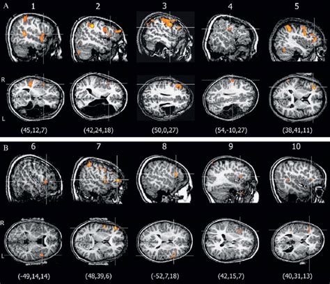 Sagittal And Axial Views Of Fmri Activation In The Frontal Cortex Download Scientific Diagram