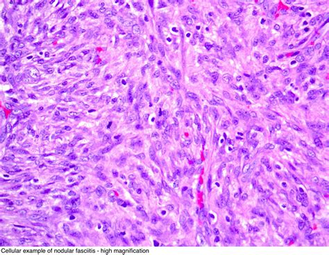 Pathology Outlines Nodular Fasciitis