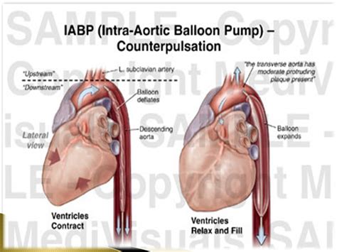 Cvt Mohd Farid Basic Intra Aortic Balloon Pump Iabp