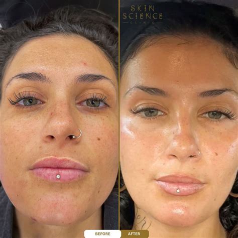 Moxi Laser Treatment Skin Science Clinic