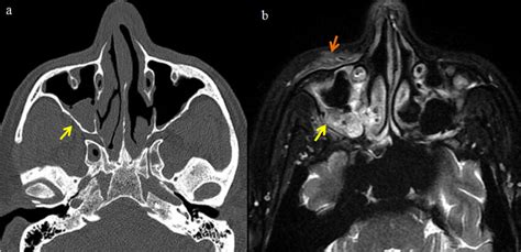 Axial Ct Bone Window Image A Shows Mucosal Thickening In Right Download Scientific Diagram