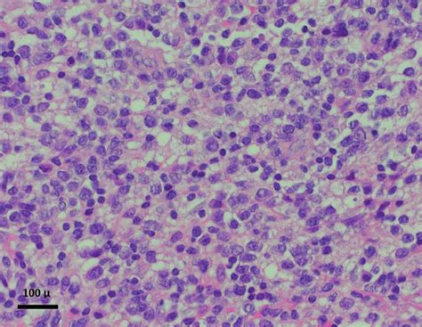 Polymorphous Population Of Variably Sized Lymphoid Cells Plasma Cells Download Scientific