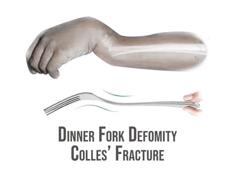 Colles Fracture Dinner Fork