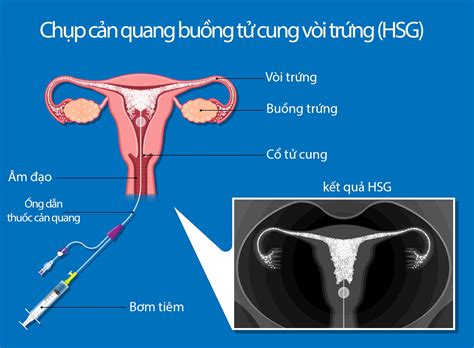 ChỤp BuỒng TỬ Cung VÒi TrỨng CÓ CẢn Quang Hsg Wiki Ivf By Ivfmd