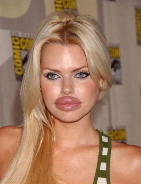 Pin On Botox And Silicone Mess Up And