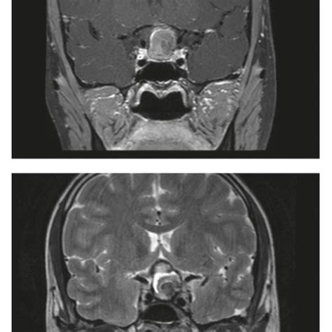 Examples Of Pituitary Adenoma And Rathke Cleft Cyst On The