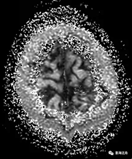 一个病例,让你深刻理解什么是异病同影 《中国ct和mri杂志》《罕少疾病杂志》 一个病例,让你深刻理解什么是异病同影 《中国ct和mri杂志》《罕少疾病杂志》