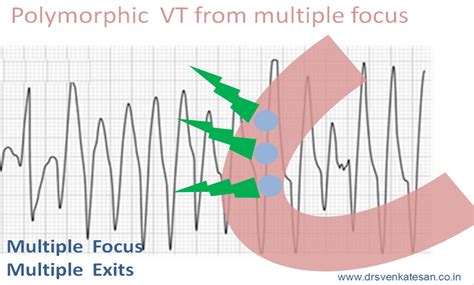 Difference Between Monomorphic And Polymorphic Ventricular Tachycardia