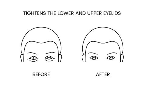 아래 눈꺼풀과 위 눈꺼풀 시술 전과 시술 라인 아이콘을 벡터에 도포 한 후에 레이저 미용을 조입니다 매끄럽고 깨끗한 피부와