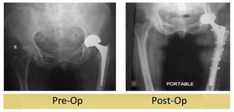 Conversion Of Bipolar To Total Hip Replacement