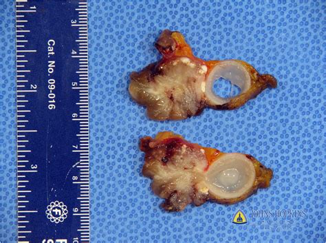 Appendix Surgical Pathology Photo Website
