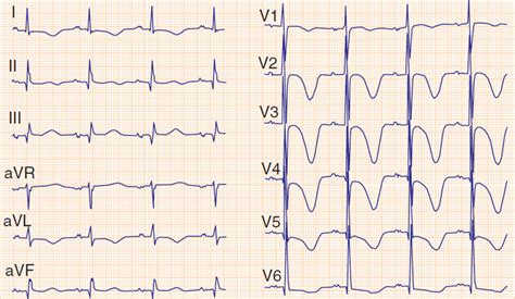 Intracranial Hypertension Ecg Book