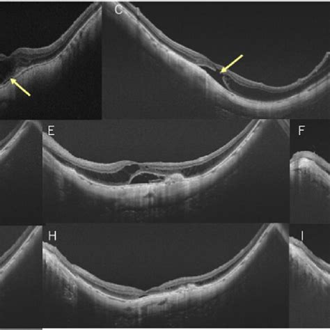 A 66 Year Old Woman With An Axial Length Of 28 63 Mm Myopic Choroidal