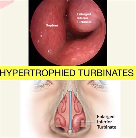 Nasal Turbinates
