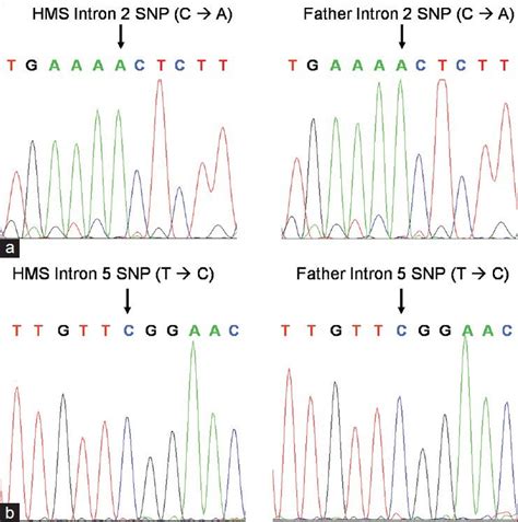 Chromatogram Of Genotypes Of The Single Nucleotide Polymorphisms Snps Download Scientific