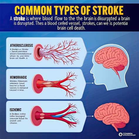 Common Types Stroke Images Free Download On Freepik