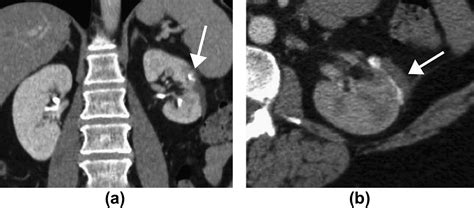 Making Sense Of Postoperative Ct Imaging Following Laparoscopic Partial