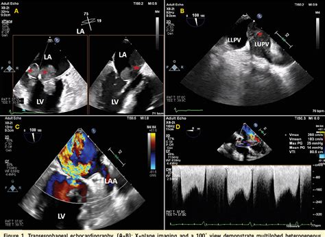 Figure 3 From Multimodality Imaging Of Intimal Sarcoma Causing Both Severe Mitral Stenosis And
