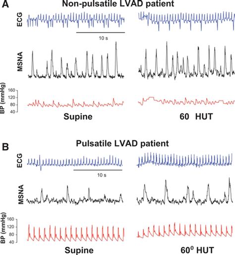 Non Pulsatile Ventricular Assist Devices