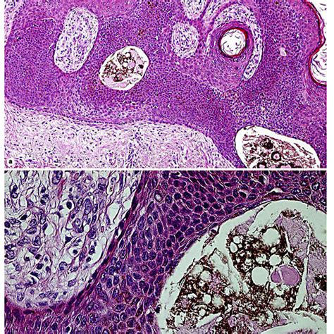 Pdf Dermoscopy Findings Of Hidroacanthoma Simplex