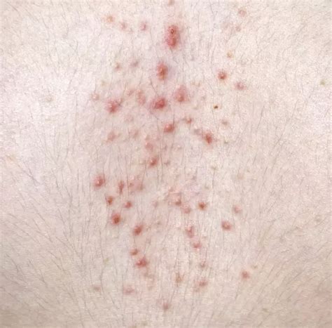 Lung Cancer Rash Pictures Identify Skin Signs
