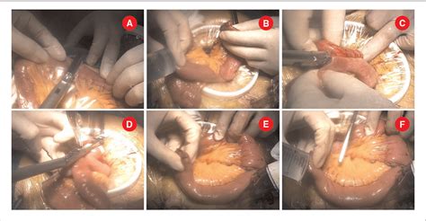 Figure 1 From Simplified Roux En Y Reconstruction After Laparoscopic