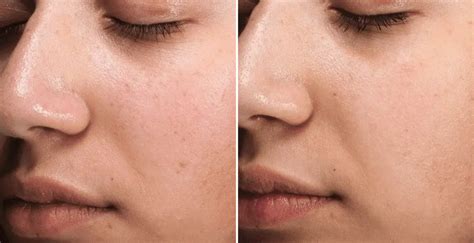 Clear Brilliant Nyc Laser Facial Results And 20 Off