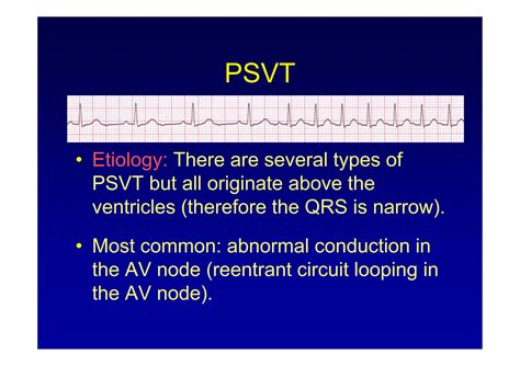 Ecg Rhythm Interpretation Ecg Rhythm Analysis Pdf