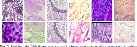 Classification Of Breast Cancer Histopathology Images Using A Modified