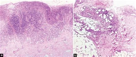 Pyoderma Gangrenosum With Marfan Syndrome And Crohns Disease A Rare Association Journal Of