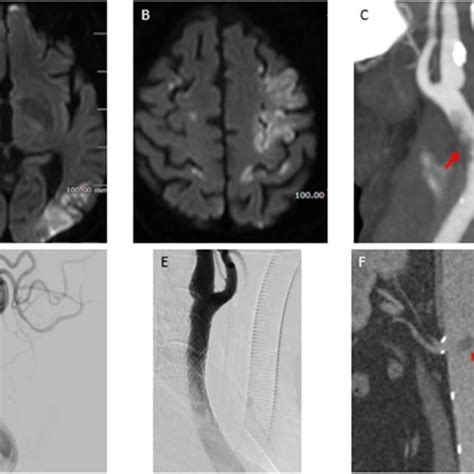 Case N 2 A B Mri Showing Left Fronto Parietal Ais On Download Scientific Diagram