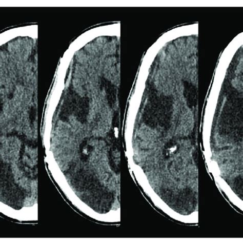 Ms Ct Images In The Subacute Stage Radiological Convention