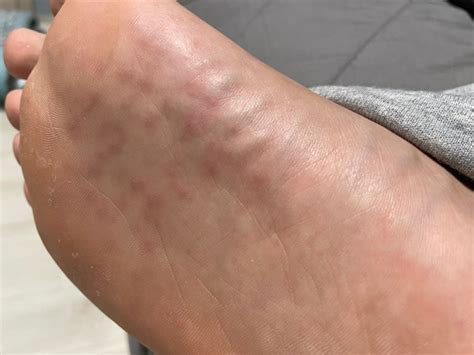발에 빨간반점 올라오는데 이게 뭔가요 지식in