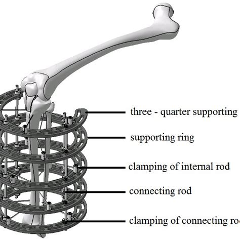 An External Fixator Of The Tibia With Grooves Version 2 Download Scientific Diagram