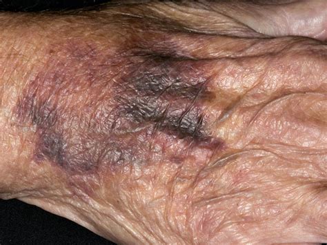 Caregiving And Blood Thinners Afc