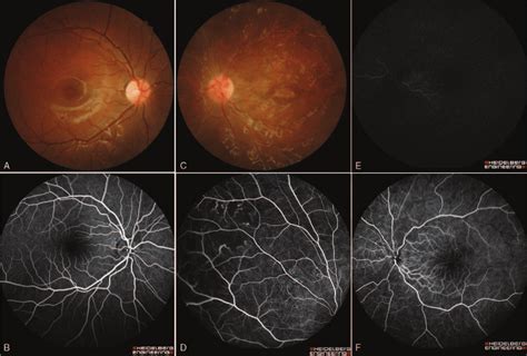 Normal Fundoscopic Exam