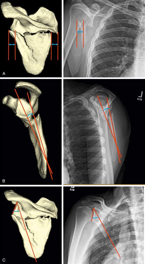 The Scapula—body Glenoid And Process Fractures Clinical Tree